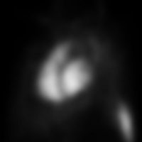 MUGA Scan – Utah Cardiology