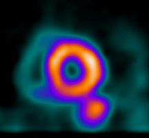 Nuclear Stress Test – Utah Cardiology